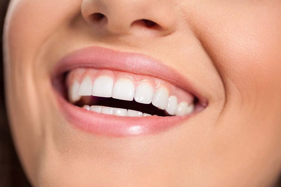 Gum Lift | Charleston Dental Studio